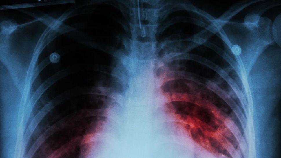 Aumento de casos de tuberculosis en niños y adolescentes