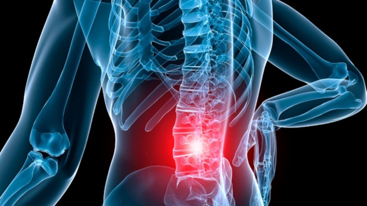 Hernia de disco: por qué es tan común y cómo prevenirla