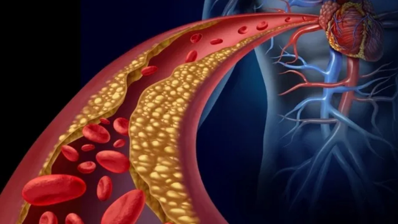 Las razones de por qué algunas personas tienen colesterol alto, aunque ...