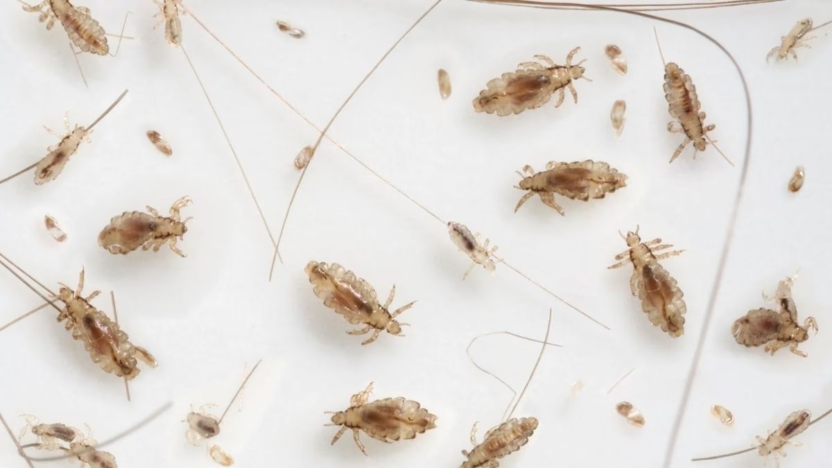 Piojos: tratamientos para eliminarlos para siempre