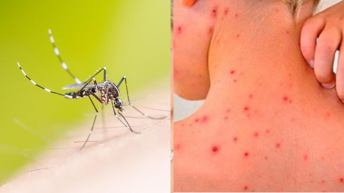 Máxima alerta en nuestro país por el sarampión y el dengue