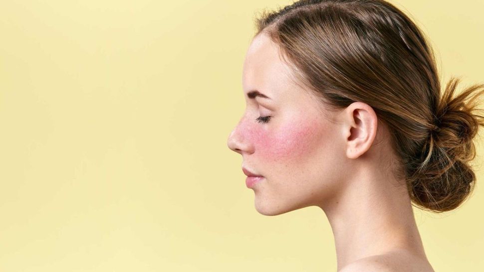 Las cosas que hay que evitar si se tiene rosácea