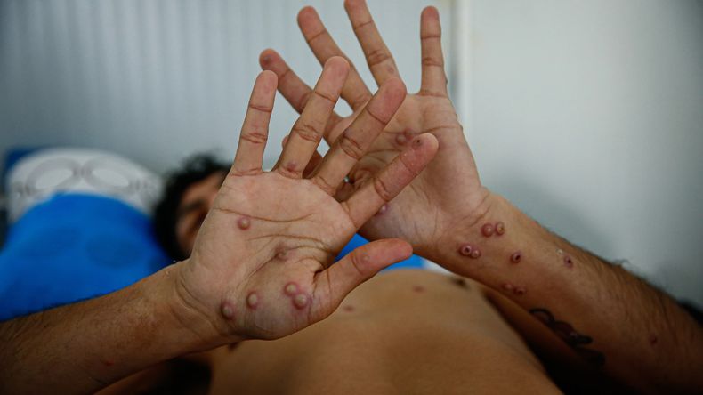 La OMS alerta por la viruela del mono: cómo se contagia, síntomas, y casos
